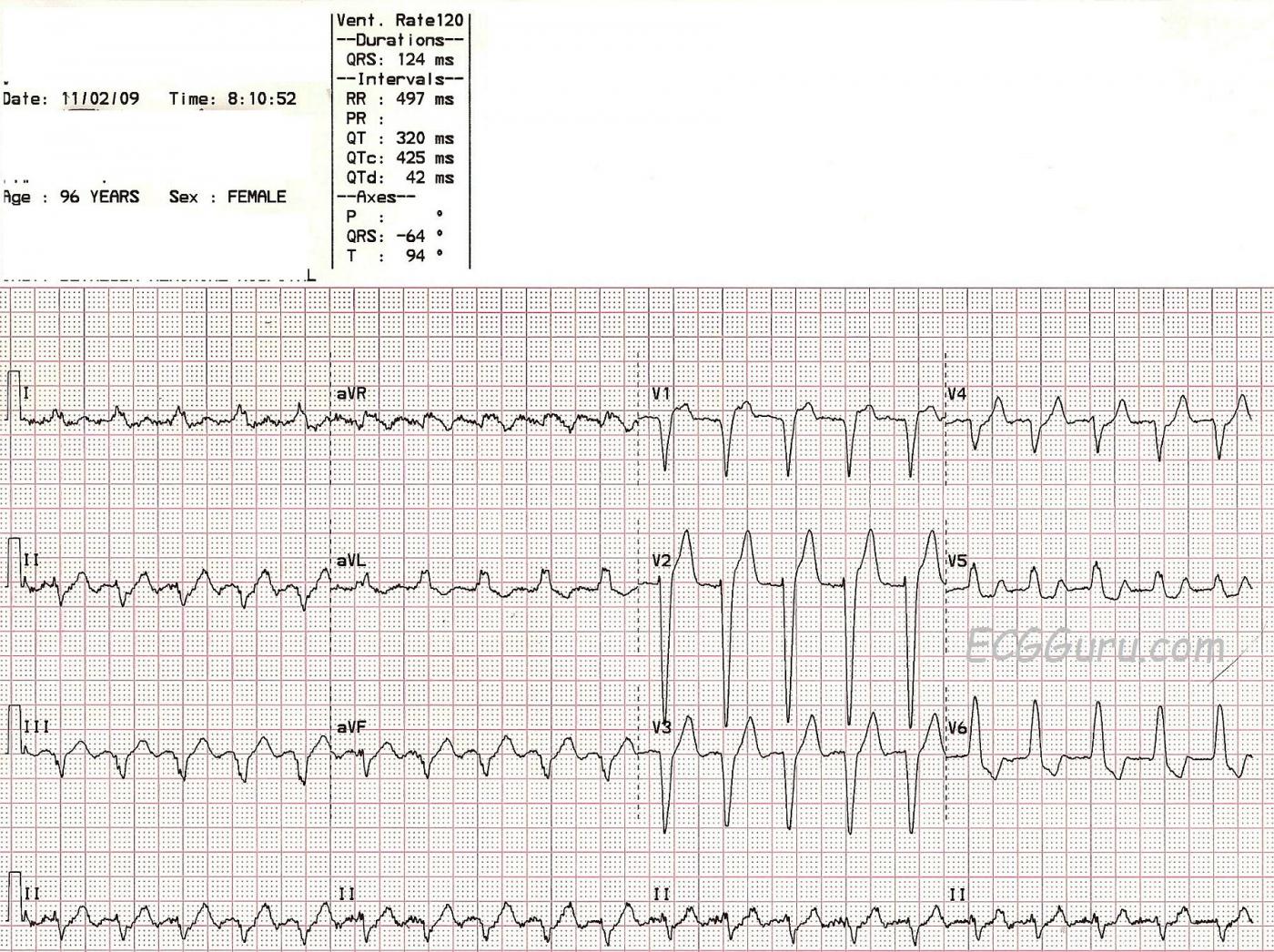 Atrial Flutter With 2:1 Conduction And Left Bundle Branch Block | ECG ... Atrial Flutter With 2:1 Conduction And Left Bundle Branch Block | ECG ...